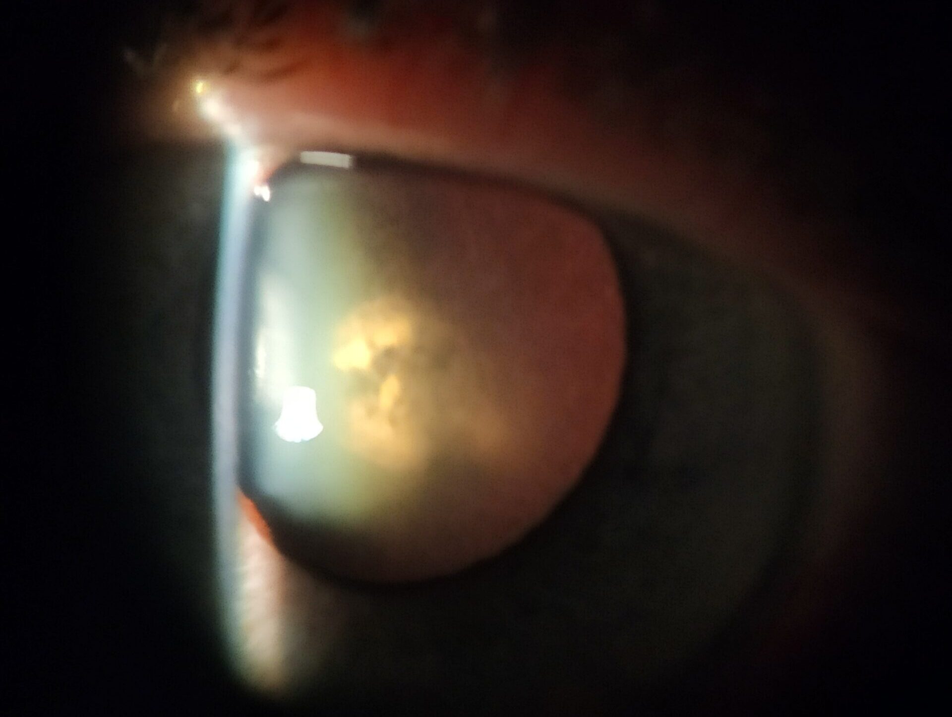 O que é catarata? – Sol Oftalmologia – Cuidado especializado na sua visão